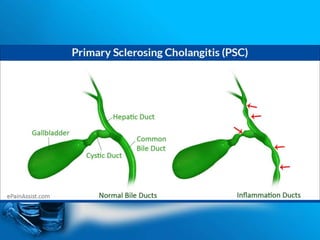 Primary Sclerosing Cholangitis (PSC) | PPTX