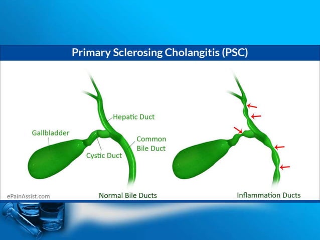 Primary Sclerosing Cholangitis (PSC)