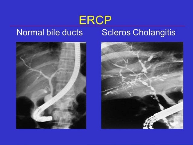 Primary Sclerosing Cholangitis (PSC)