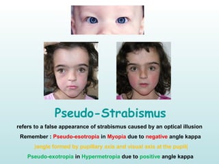 Pseudo-Ophthalmology ! | PPT
