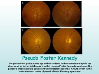 Pseudo-Ophthalmology ! | PPT