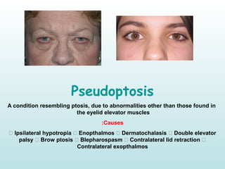 Pseudo-Ophthalmology ! | PPT