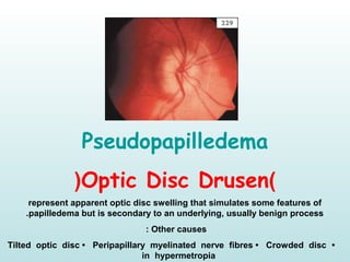 Pseudo-Ophthalmology ! | PPT