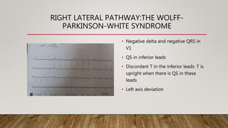 Pseudo infarction | PPT