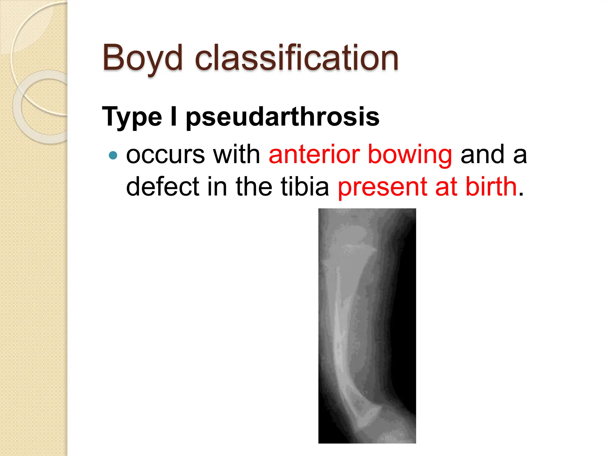pseudoarthrosis of tibia.pptx