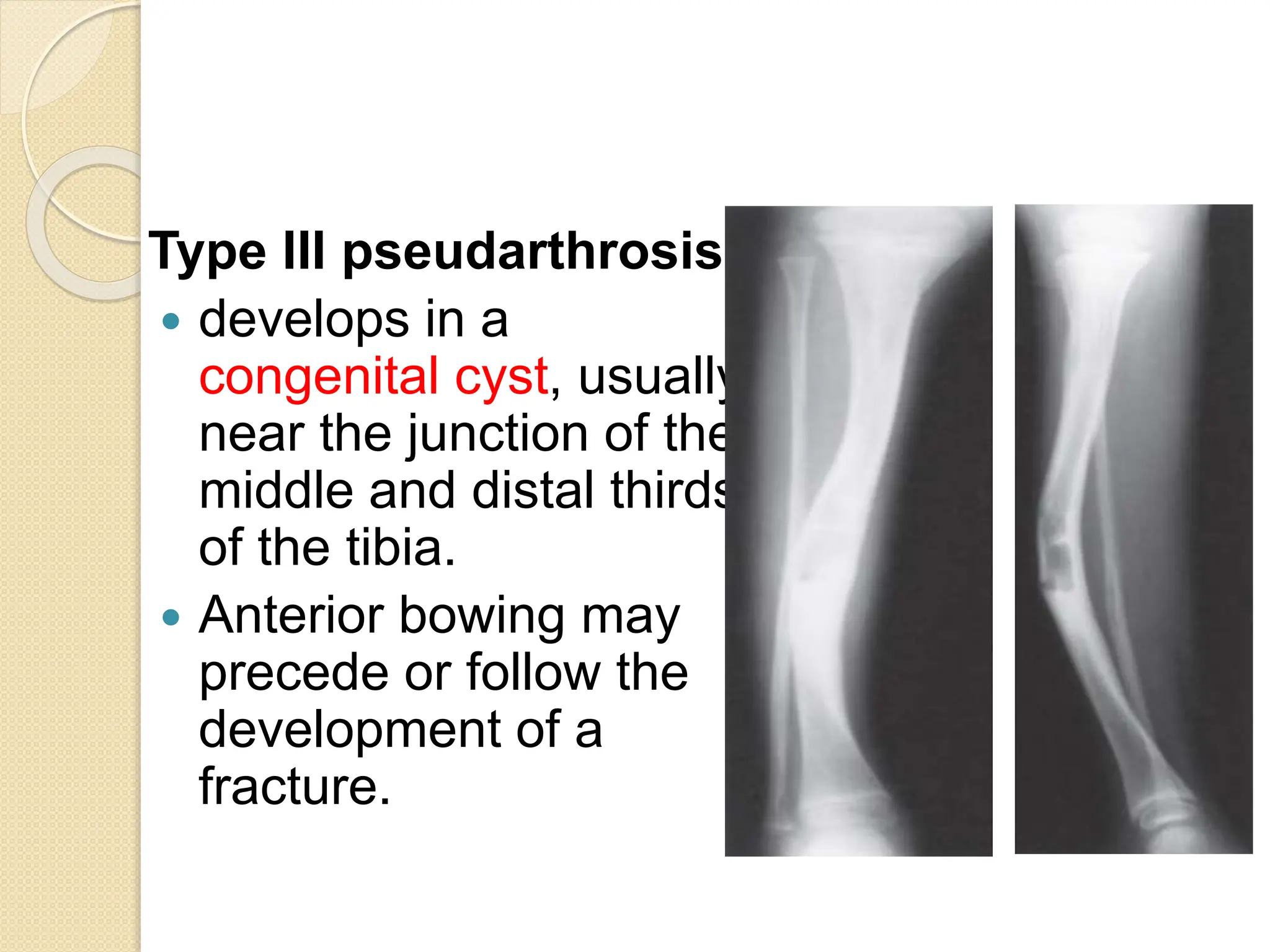 pseudoarthrosis of tibia.pptx