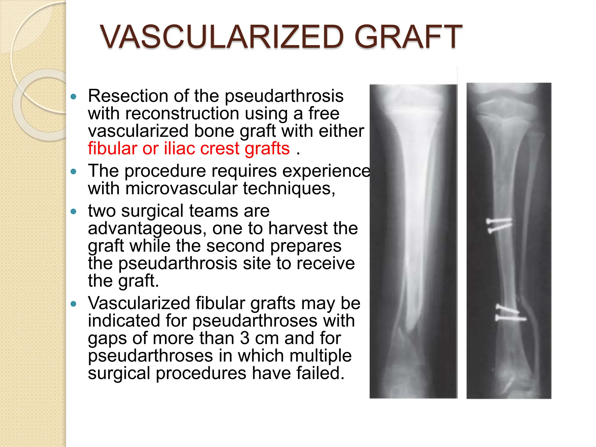 pseudoarthrosis of tibia.pptx