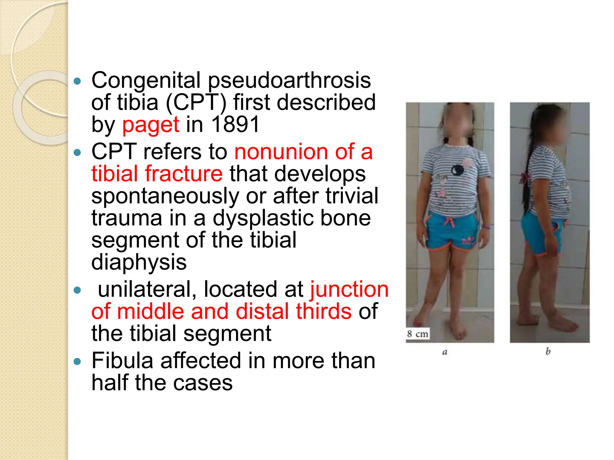 pseudoarthrosis of tibia.pptx