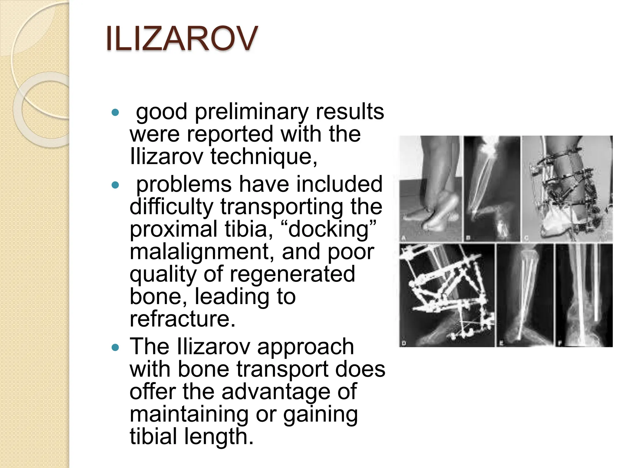 pseudoarthrosis of tibia.pptx