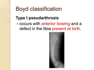 pseudoarthrosis of tibia.pptx