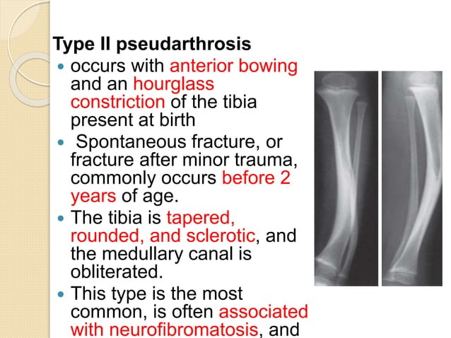 pseudoarthrosis of tibia.pptx | Death, Injury, or Military Conflict ...