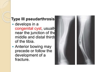 pseudoarthrosis of tibia.pptx
