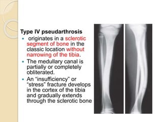 pseudoarthrosis of tibia.pptx