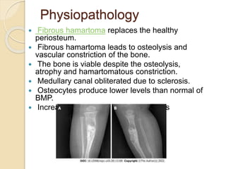 pseudoarthrosis of tibia.pptx