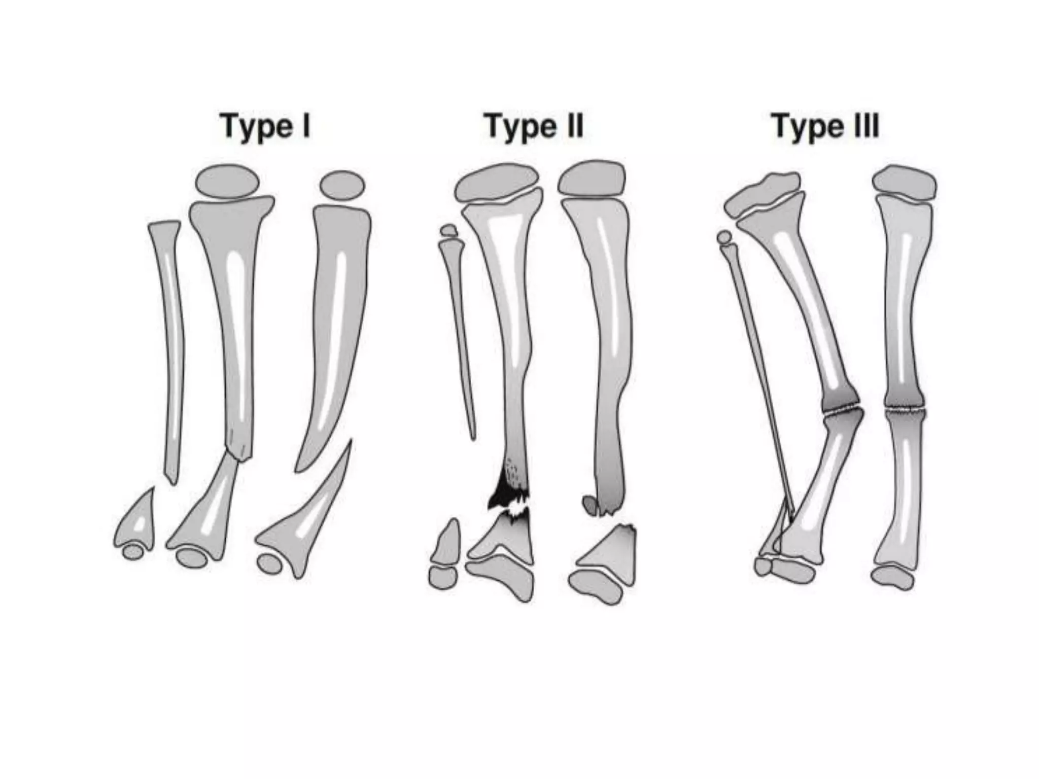 Pseudoarthrosis tibia | PPTX