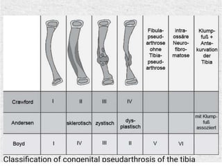 Pseudoarthrosis tibia | PPTX