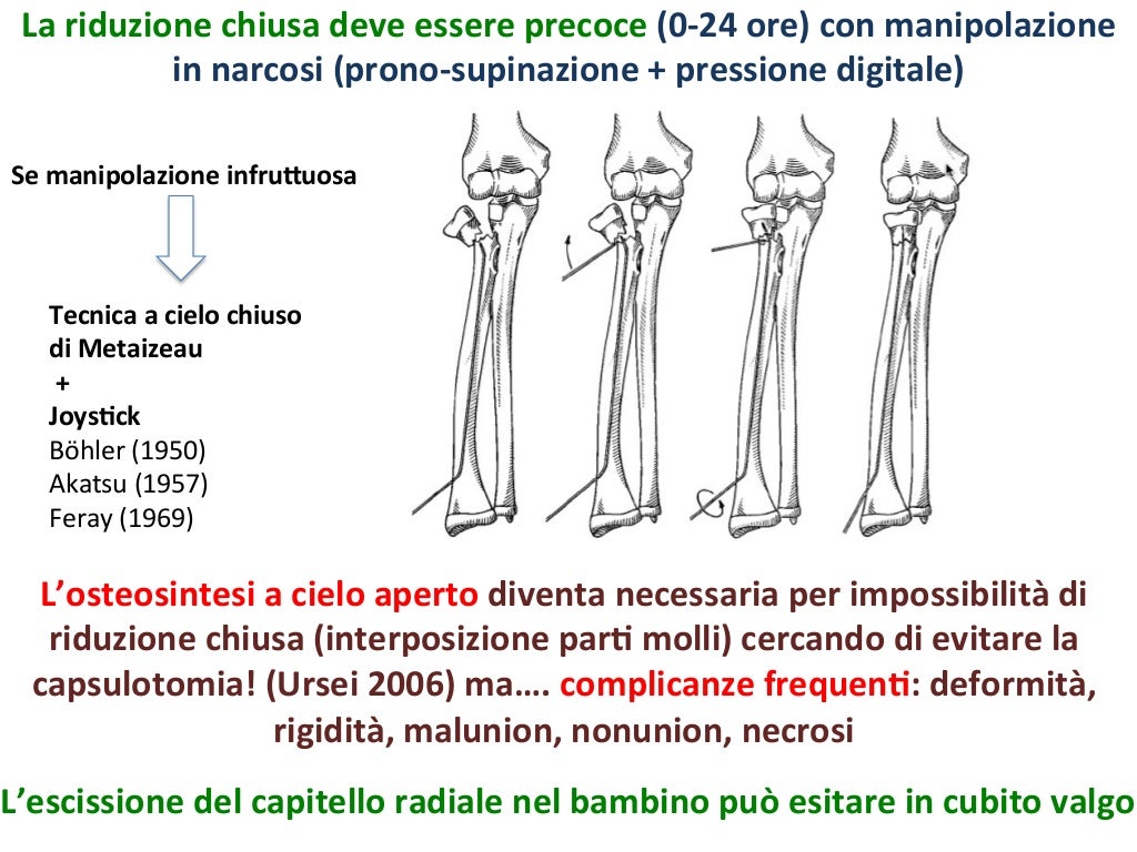 Pseudoartrosi capitello radiale nel bambino: caso clinico (seondo cor…