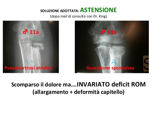 Pseudoartrosi capitello radiale nel bambino: caso clinico (seondo cor…