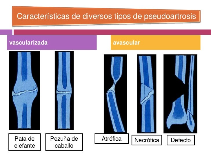 CLASIFICACION DE PSEUDOARTROSIS PDF