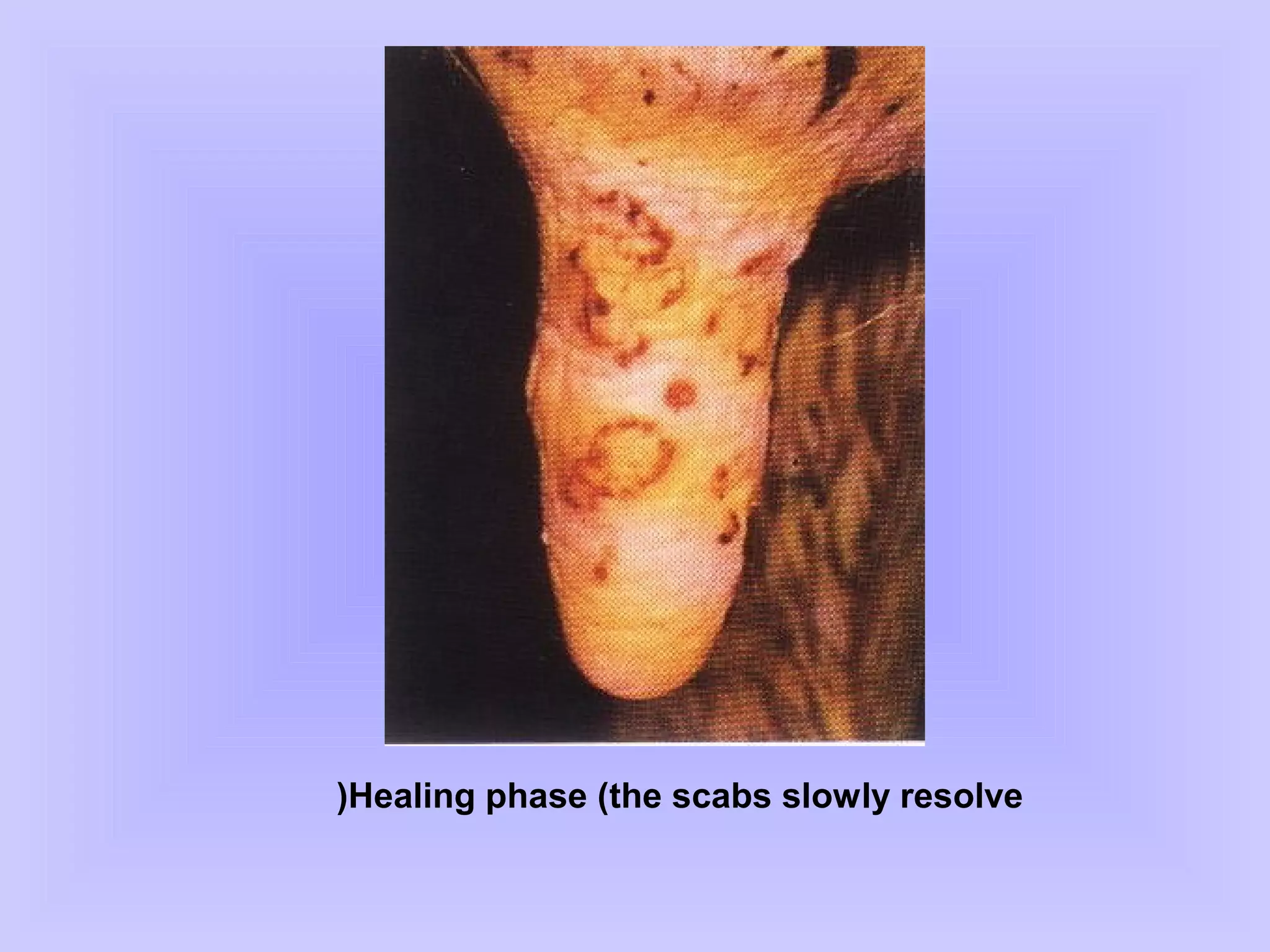 Pseudo cow pox | PPS