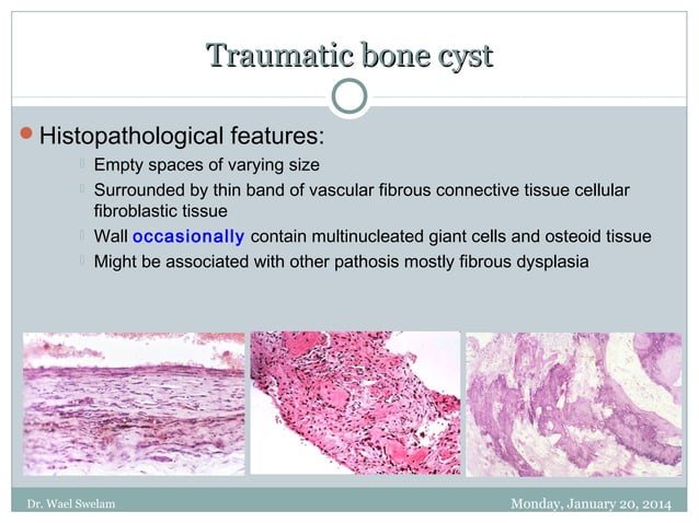 Pseudo cyst | PPS | Bone and Joint Conditions | Diseases and Conditions