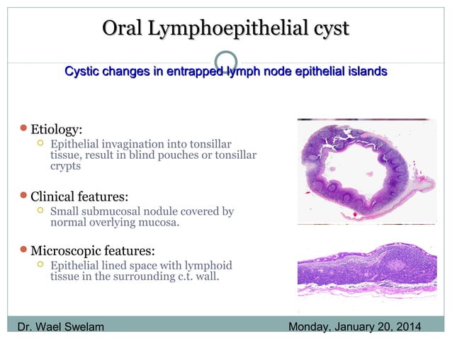 Pseudo cyst | PPS | Bone and Joint Conditions | Diseases and Conditions