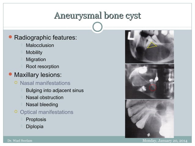 Pseudo cyst | PPS | Bone and Joint Conditions | Diseases and Conditions