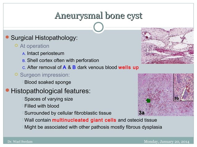 Pseudo cyst | PPS | Bone and Joint Conditions | Diseases and Conditions