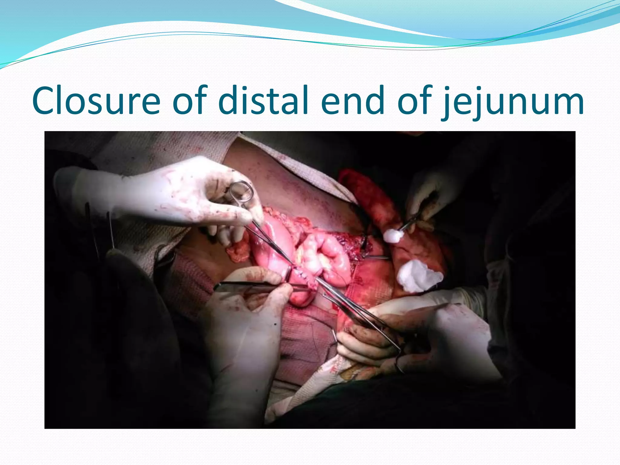 Pseudocyst of pancreas | PPTX