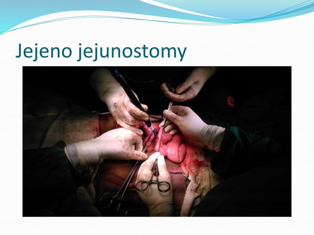 Pseudocyst of pancreas | PPTX