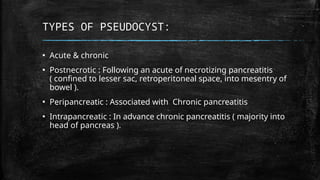 Management of Pseudocyst Of Pancreas.pptx