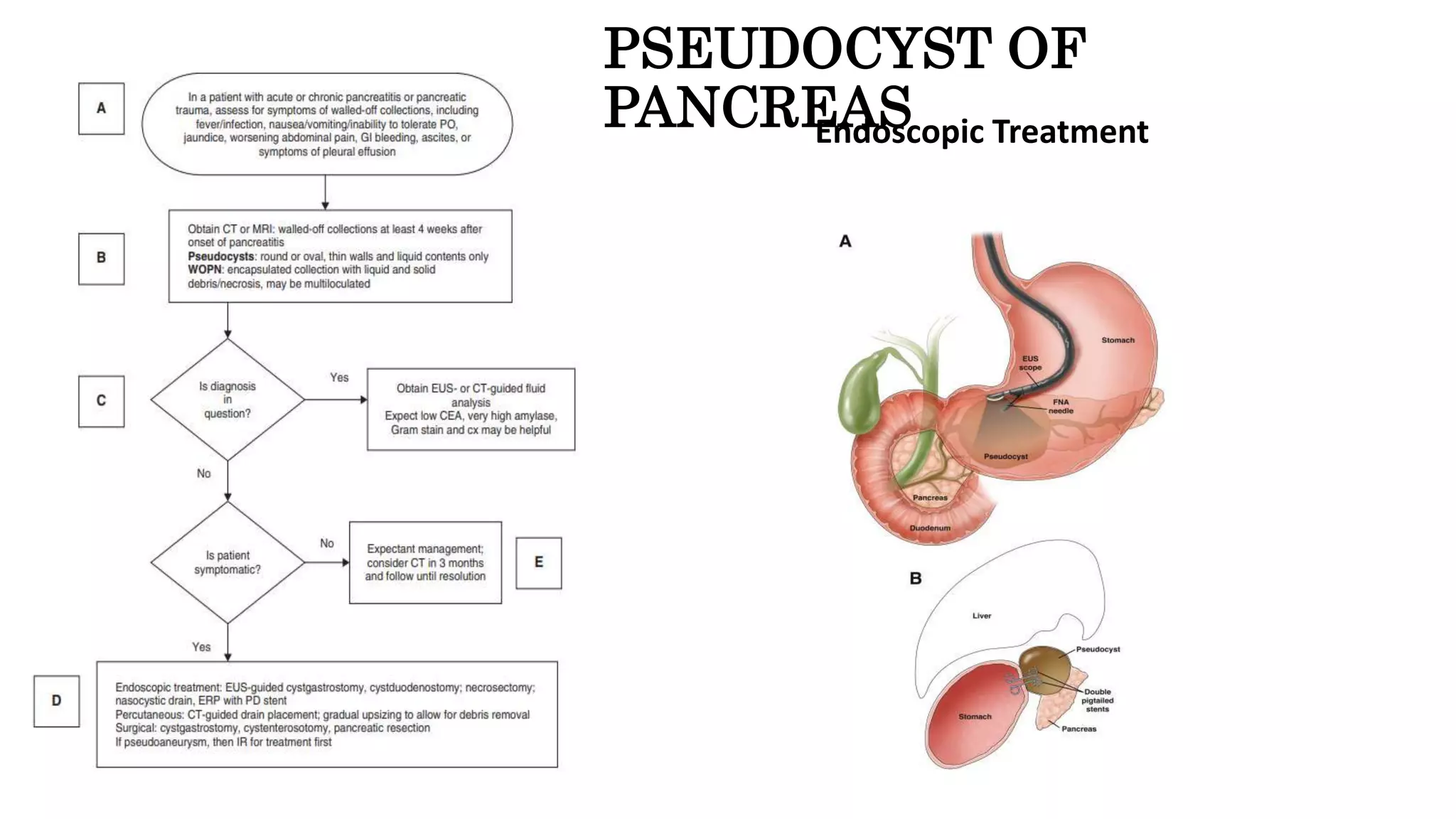 Pseudocyst of Pancreas- How to DIAGNOSE & TREAT- Epigastric Lumps ...