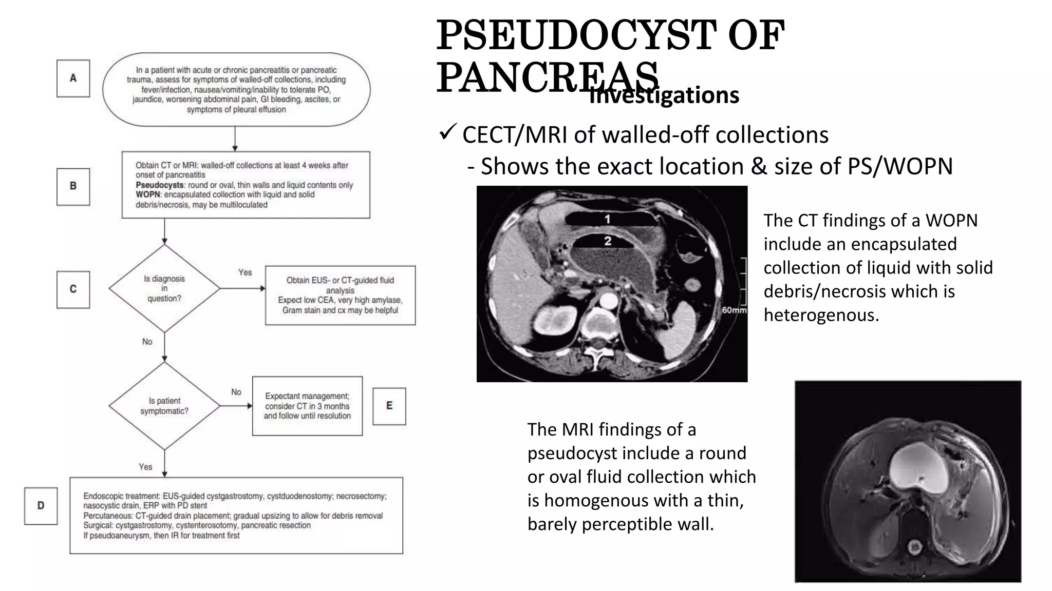 Pseudocyst of Pancreas- How to DIAGNOSE & TREAT- Epigastric Lumps ...