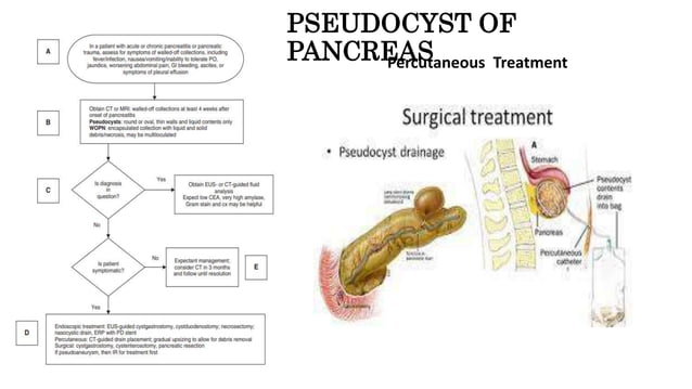 Pseudocyst of Pancreas- How to DIAGNOSE & TREAT- Epigastric Lumps ...