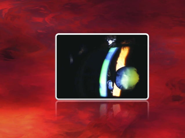 Pseudoexfoliation glaucoma | PPT