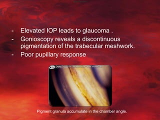 Pseudoexfoliation Gonioscopy