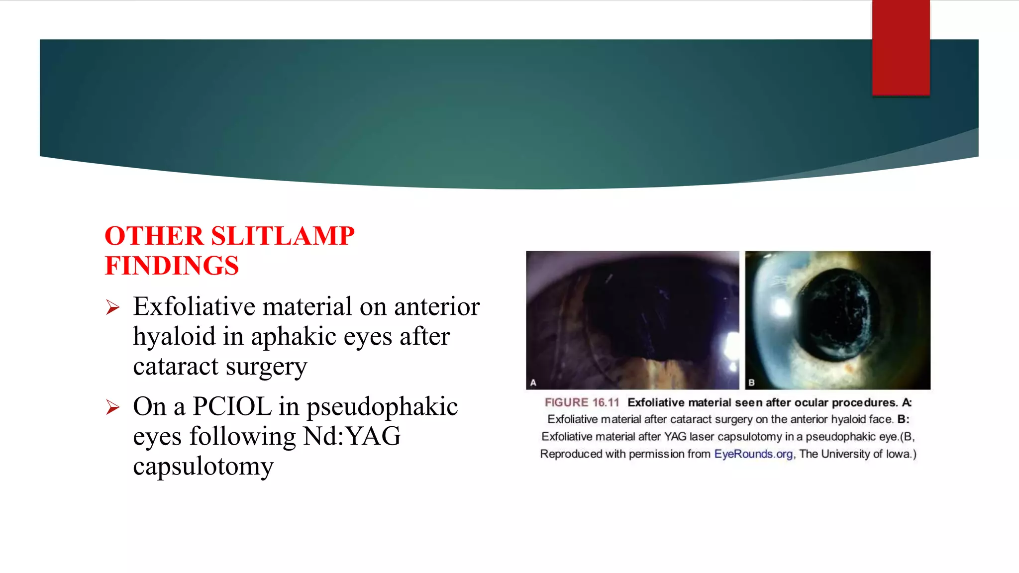 PSEUDOEXFOLIATION GLAUCOMA.pptx | Eye and Vision Conditions | Diseases ...
