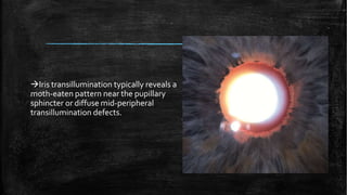 pseudoexfoliationsyndrome-170426175648.pptx