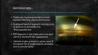 pseudoexfoliationsyndrome-170426175648.pptx