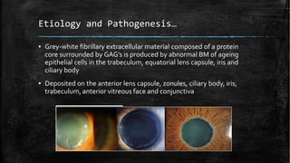 Pseudoexfoliation Transillumination Defects