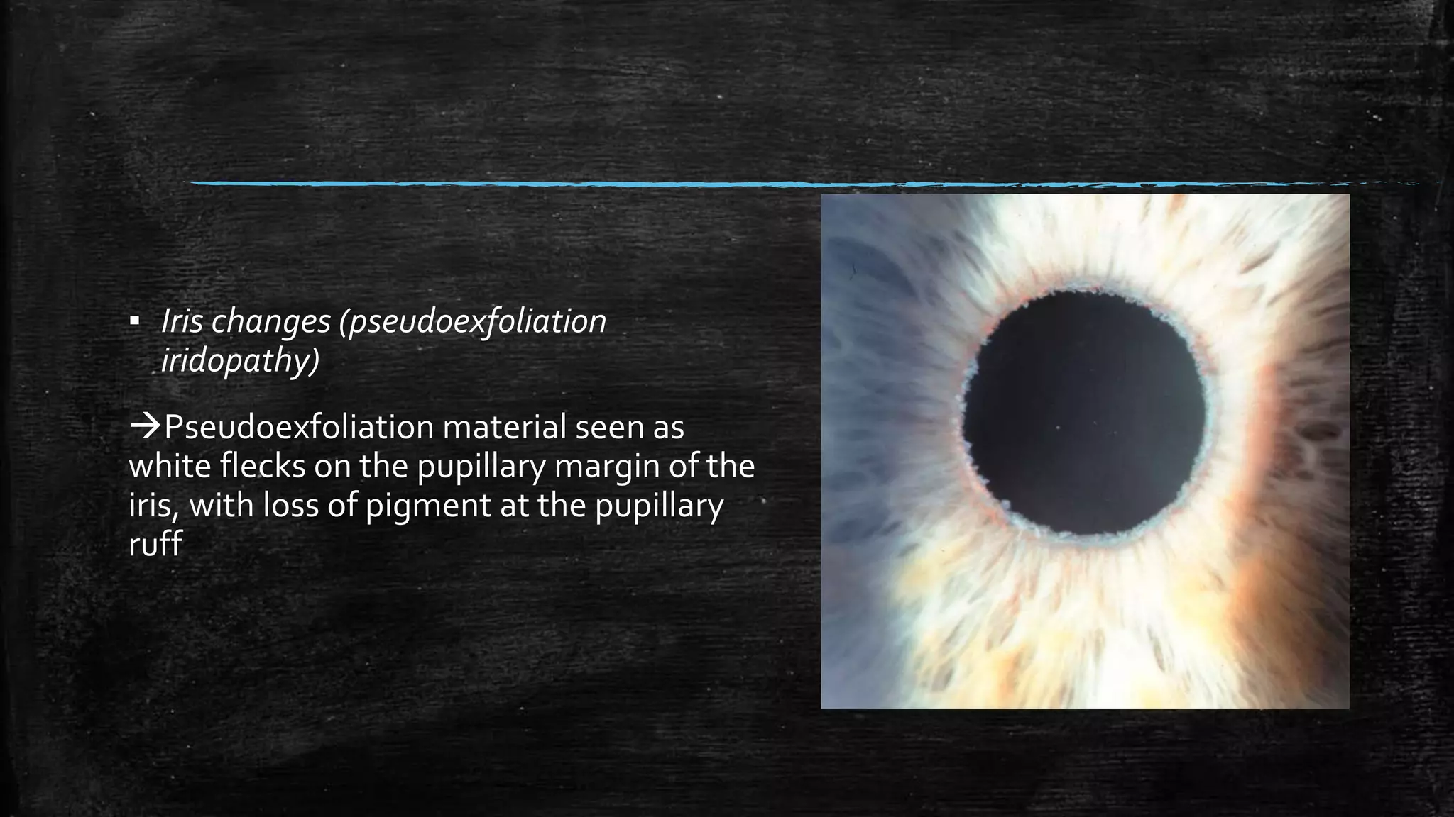 Pseudoexfoliation syndrome | PPTX