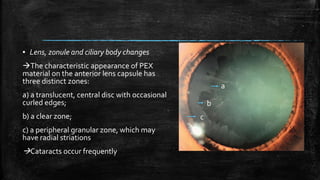 Pseudoexfoliation syndrome | PPTX