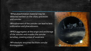 Pseudoexfoliation syndrome | PPTX