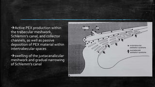 Pseudoexfoliation syndrome | PPTX