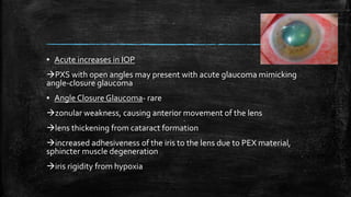 Pseudoexfoliation syndrome | PPTX