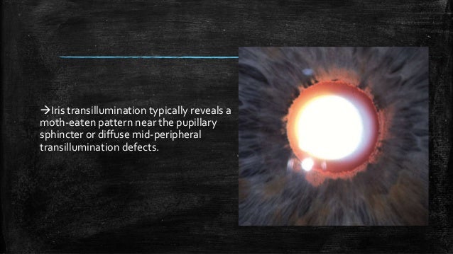Pseudoexfoliation syndrome
