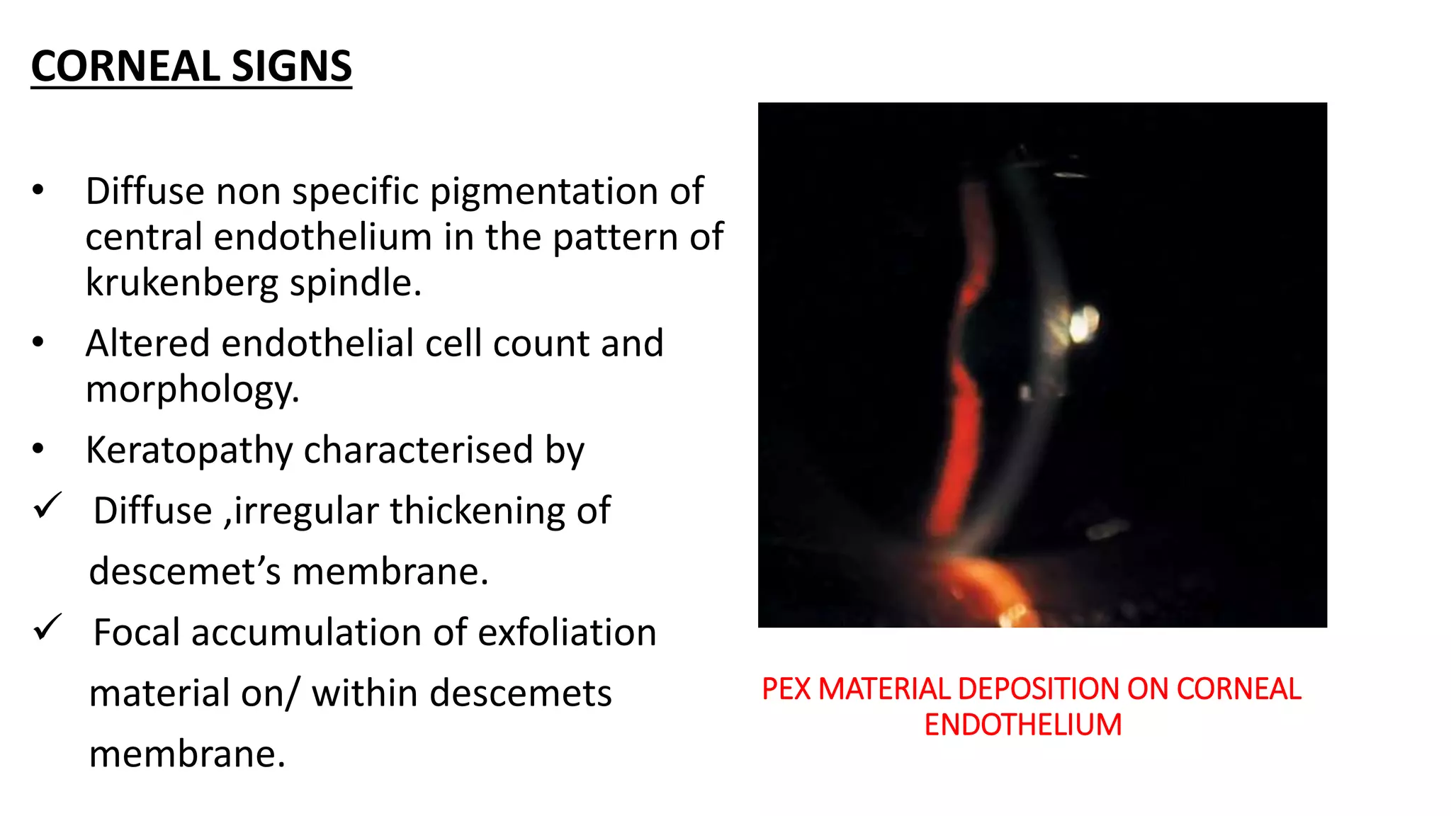 Pseudoexfoliative glaucoma seminar | PPTX