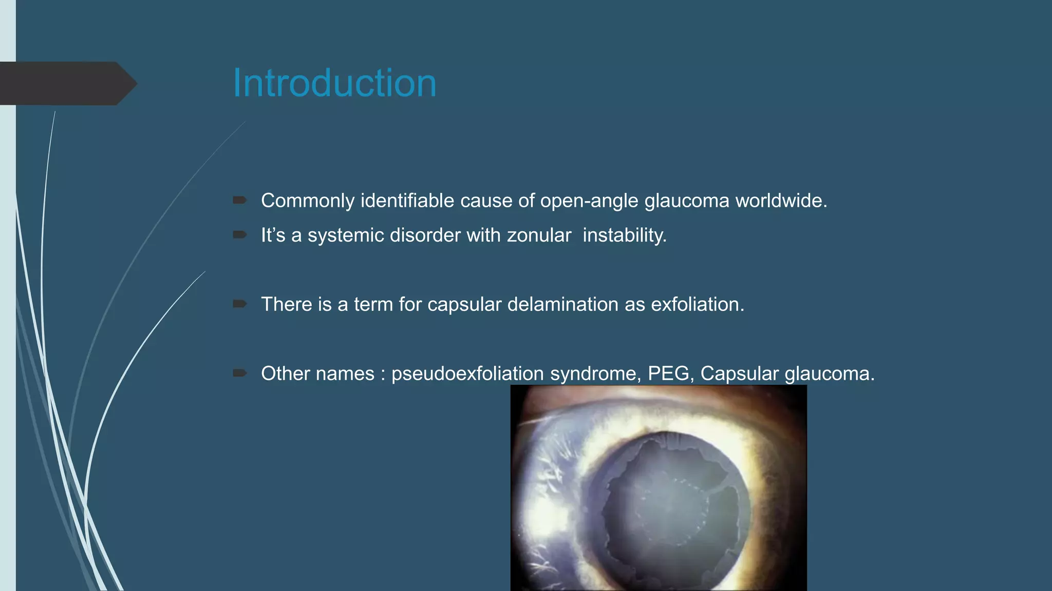 Pseudoexfoliative syndrome and pigment dispersion syndrome and glaucoma ...