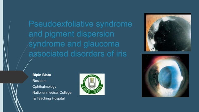 Pseudoexfoliative syndrome and pigment dispersion syndrome and glaucoma ...