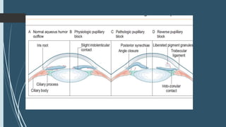 Pseudoexfoliative syndrome and pigment dispersion syndrome and glaucoma ...